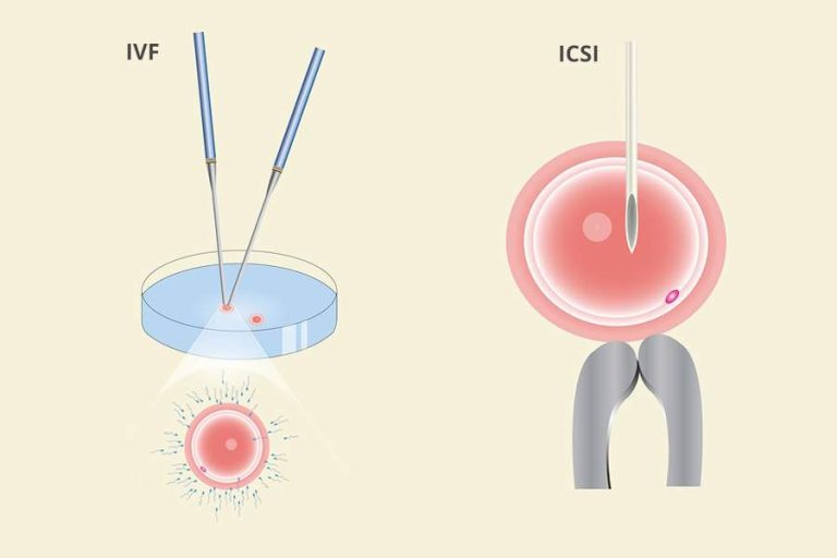 Is ICSI better than IVF (ICSI VS IVF) - Dr. Sumita Sofat Hospital